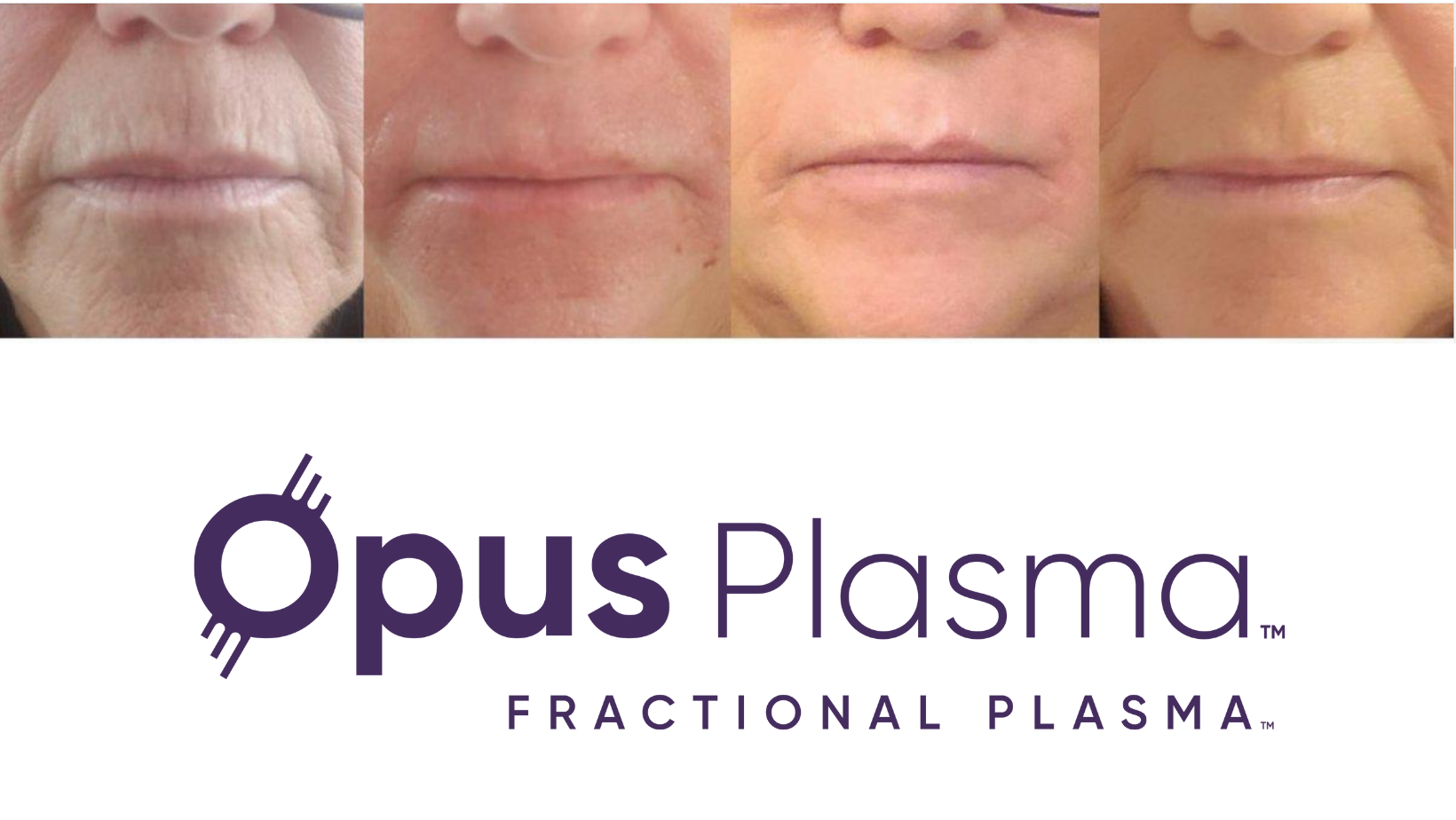 Opus Plasma Skin Resurfacing - Shot Shop Med Spa
