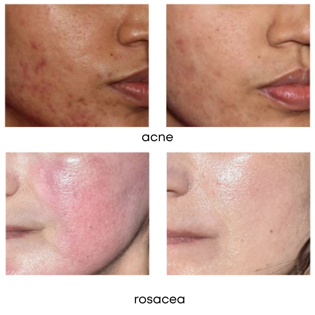 AdvaTX Laser Skin Resurfacing - Shot Shop Med Spa